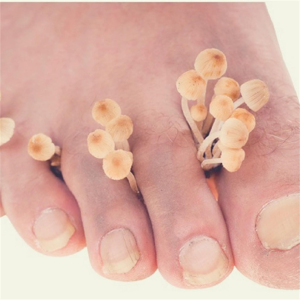 Que Es El Pie De Atleta Imagenes at Hudson Becher blog